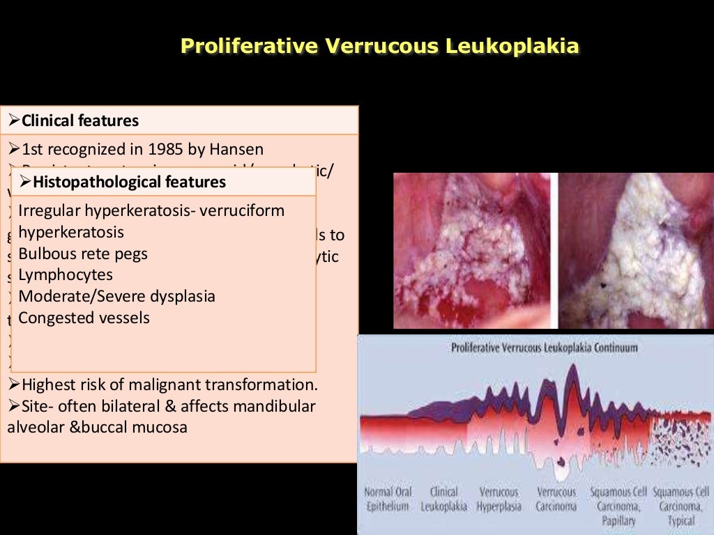 Leukoplakia