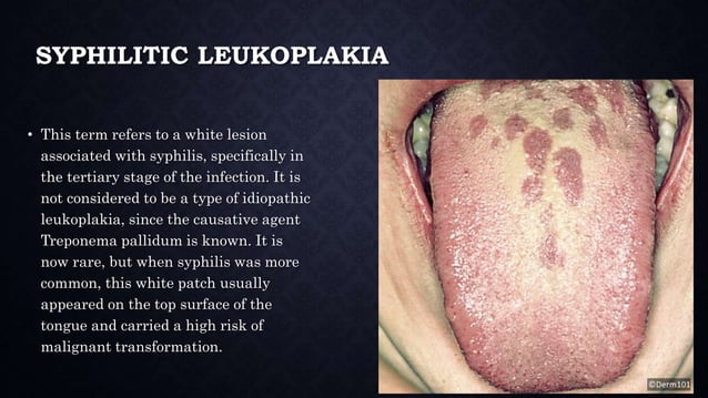 Leukoplakia | PPT