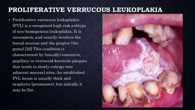 Leukoplakia
