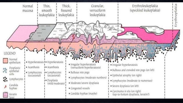 Leukoplakia