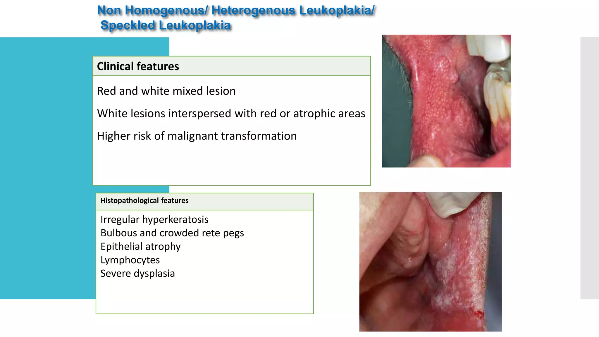 Pre cancerous lesion and condition | PPTX