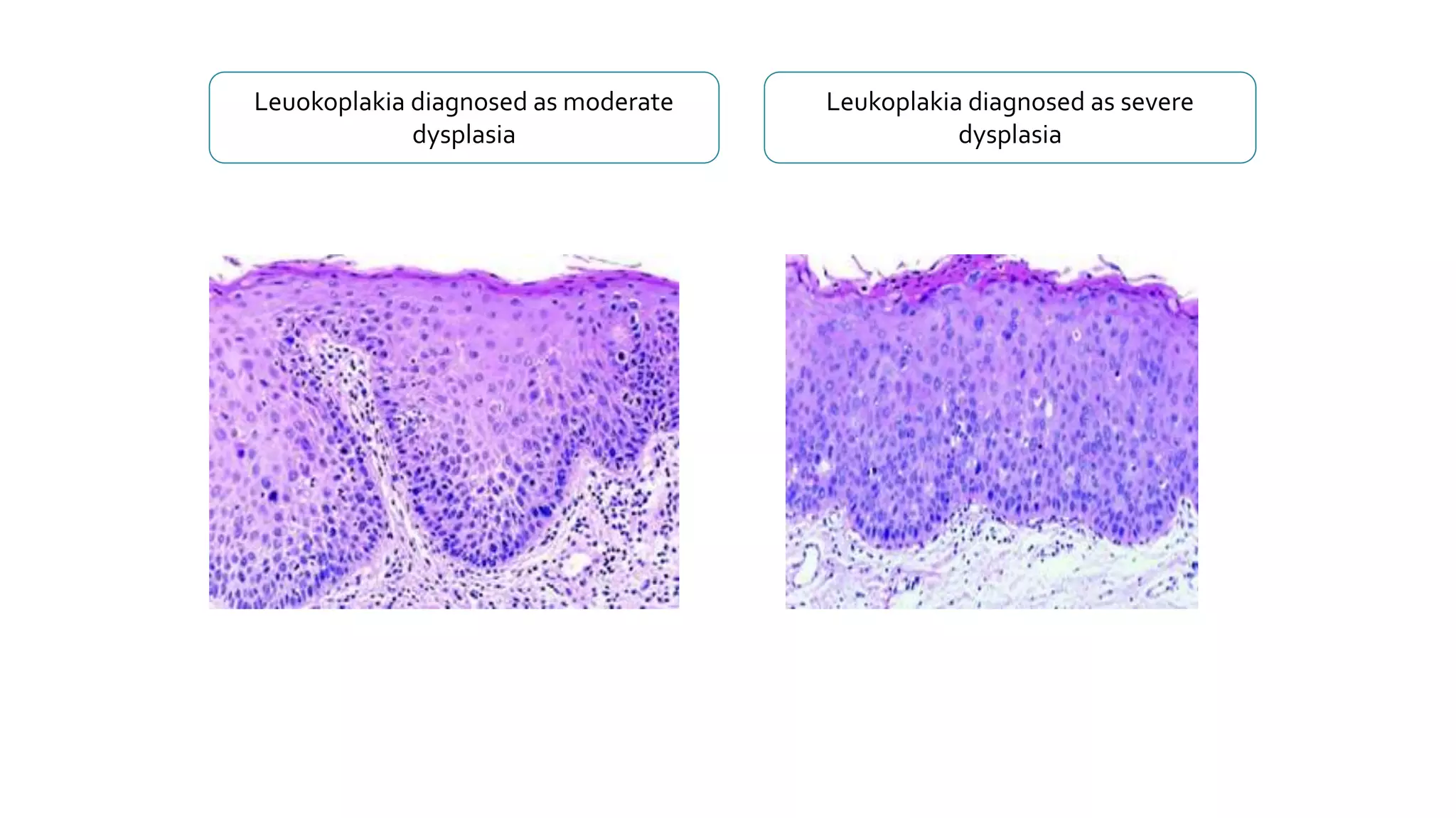 Pre cancerous lesion and condition | PPTX