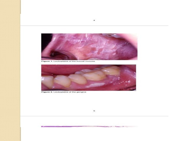 Leukoplakia | PPTX | Dental Health | Diseases and Conditions