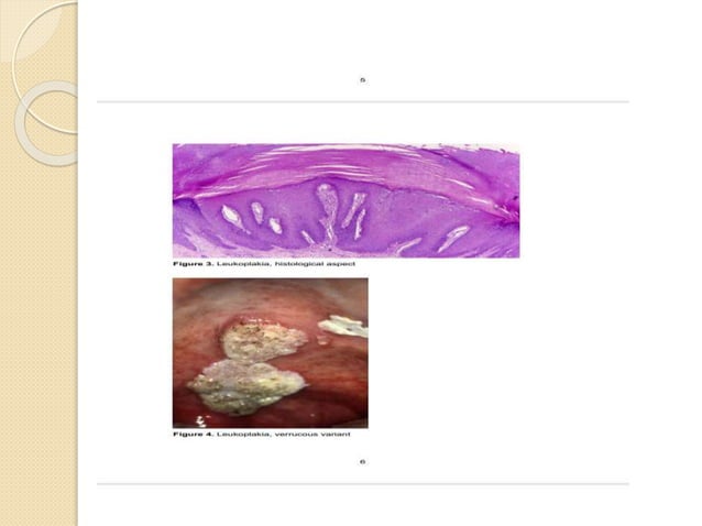 Leukoplakia | PPTX | Dental Health | Diseases and Conditions