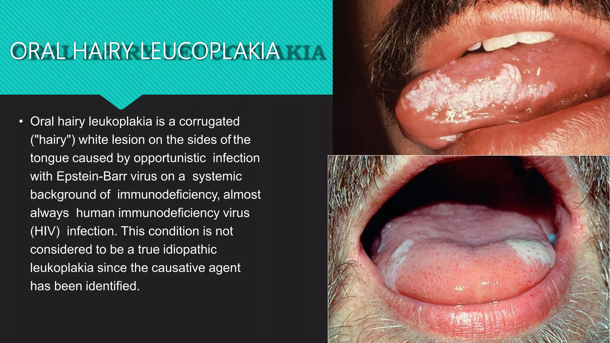 Leukoplakia | PPTX