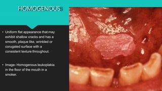 Leukoplakia | PPTX