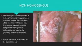 Leukoplakia | PPTX
