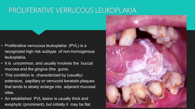 Leukoplakia | PPTX | Dental Health | Diseases and Conditions