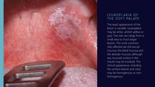 Leukoplakia | PPTX