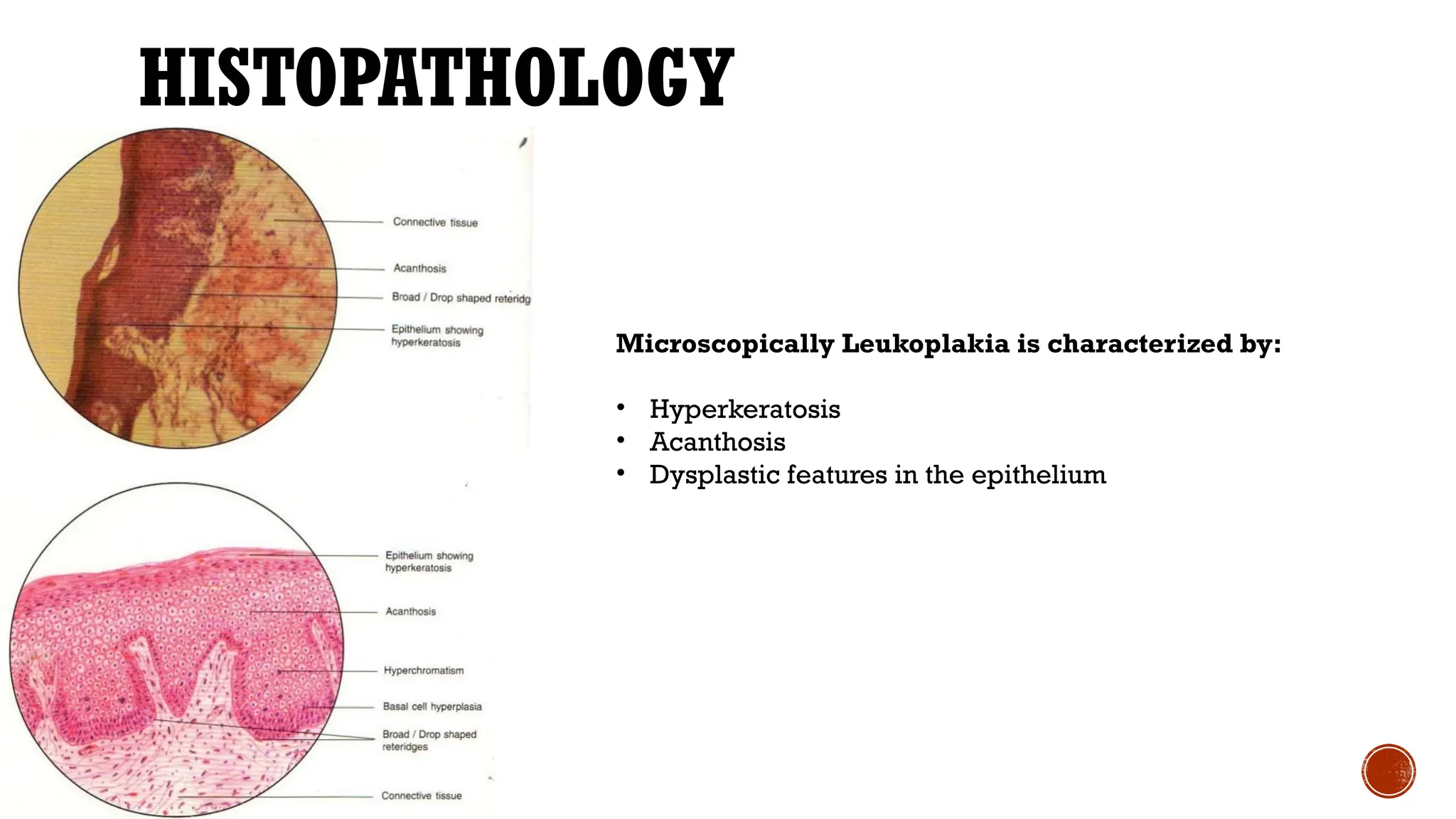 leukoplakia, oral medicine and pathology, BDS | PPTX