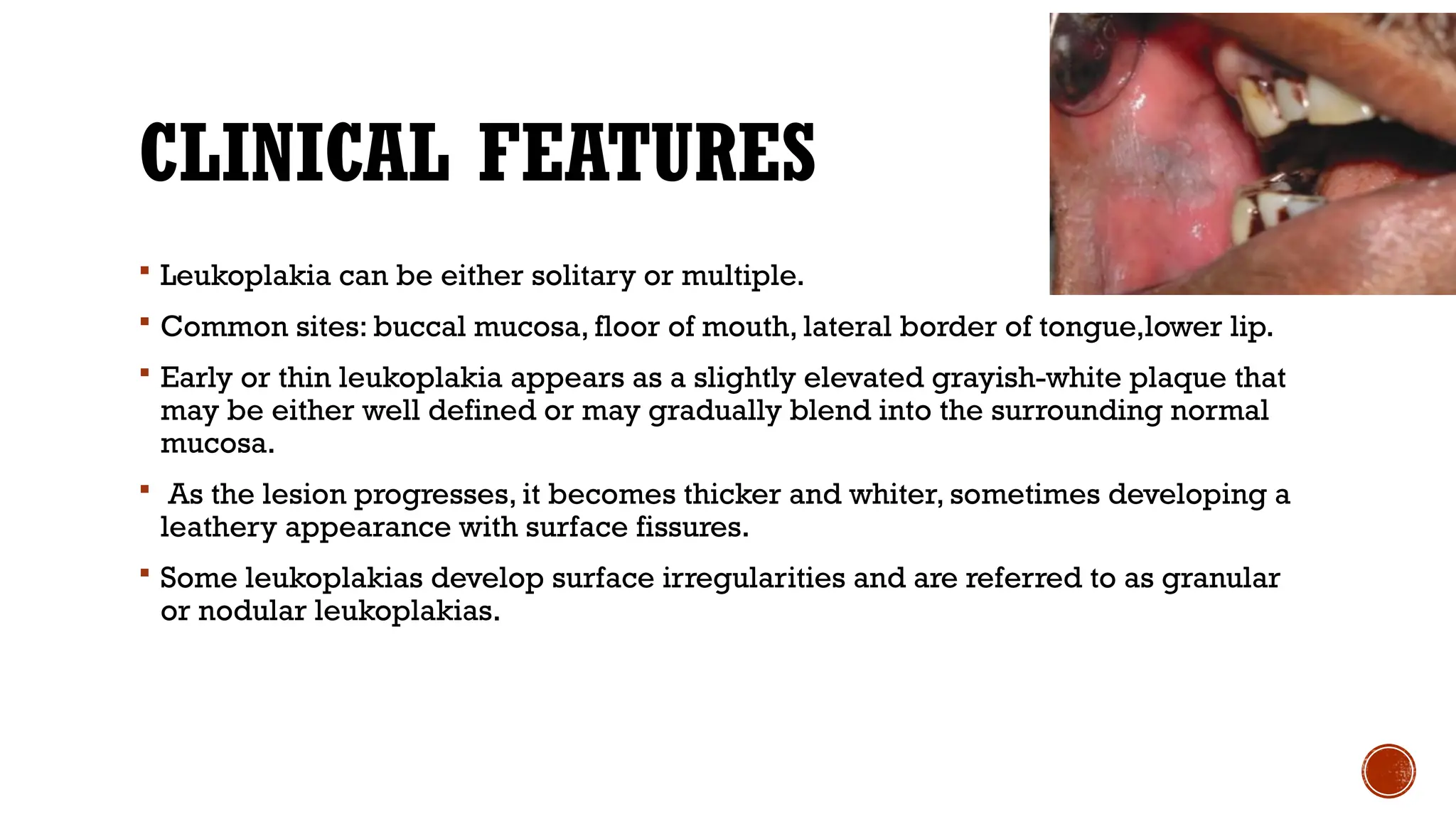 leukoplakia, oral medicine and pathology, BDS | PPTX