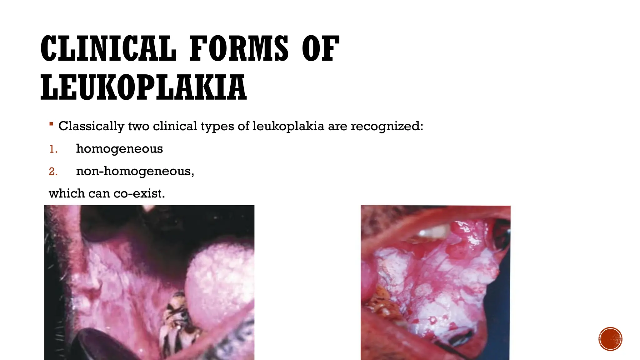 leukoplakia, oral medicine and pathology, BDS | PPTX