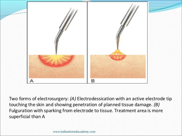 Leukoplakia1/cosmetic dentistry courses