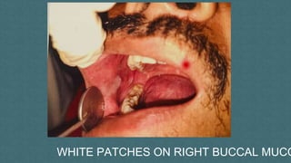 Leukoplakia (case presentation) and investigation of premalignant ...