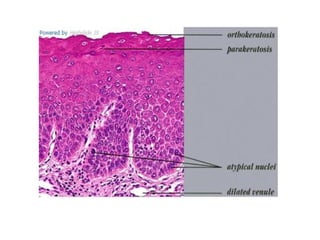 leukoplakia & erythroplakia.pptx oral tumour | PPTX
