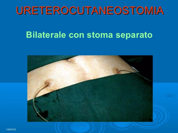 Le urostomie: prima parte
