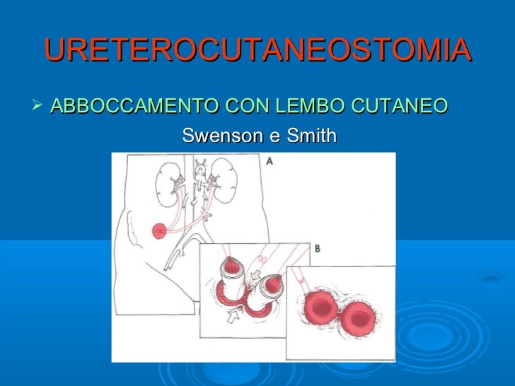 Le urostomie: prima parte