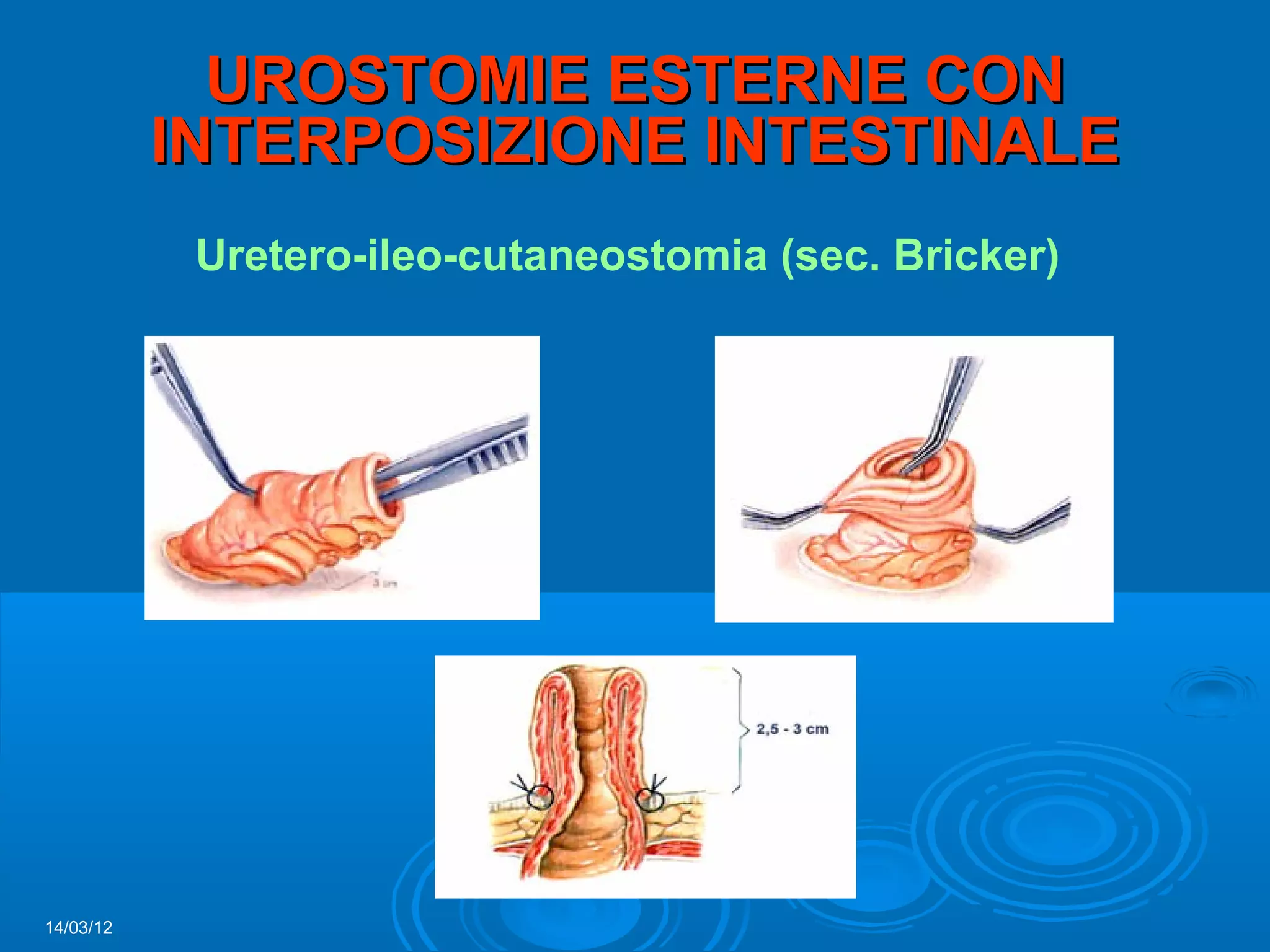 Le urostomie: seconda parte | PPT