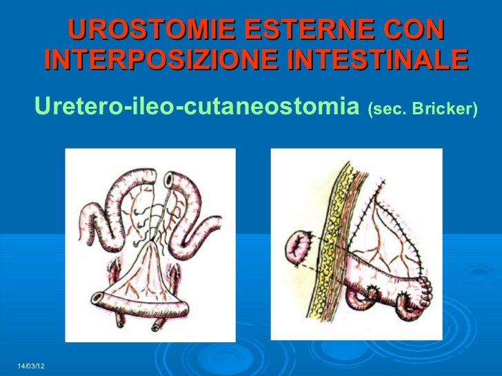 Le urostomie: seconda parte