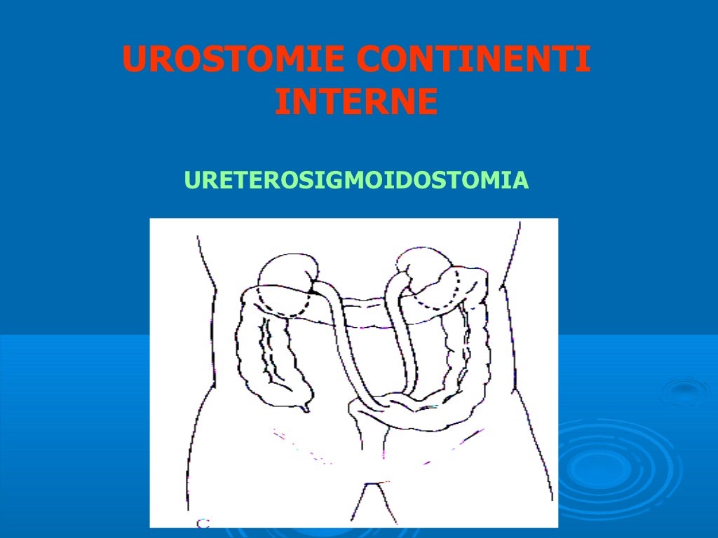 Le urostomie: seconda parte