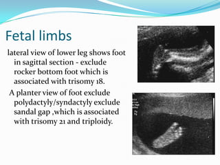 Rocker Bottom Feet Ultrasound