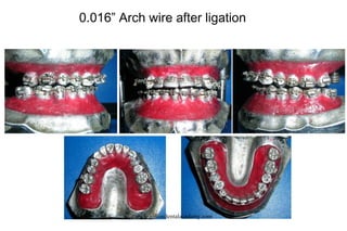 Leveling and alignment | PPT