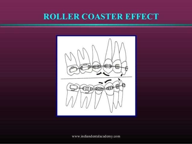 Levelling and aligning in orthodontics /certified fixed orthodontic c…