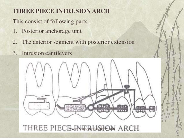 Levelling and aligning in Pre Adjusted edge wise technique in orthodo…