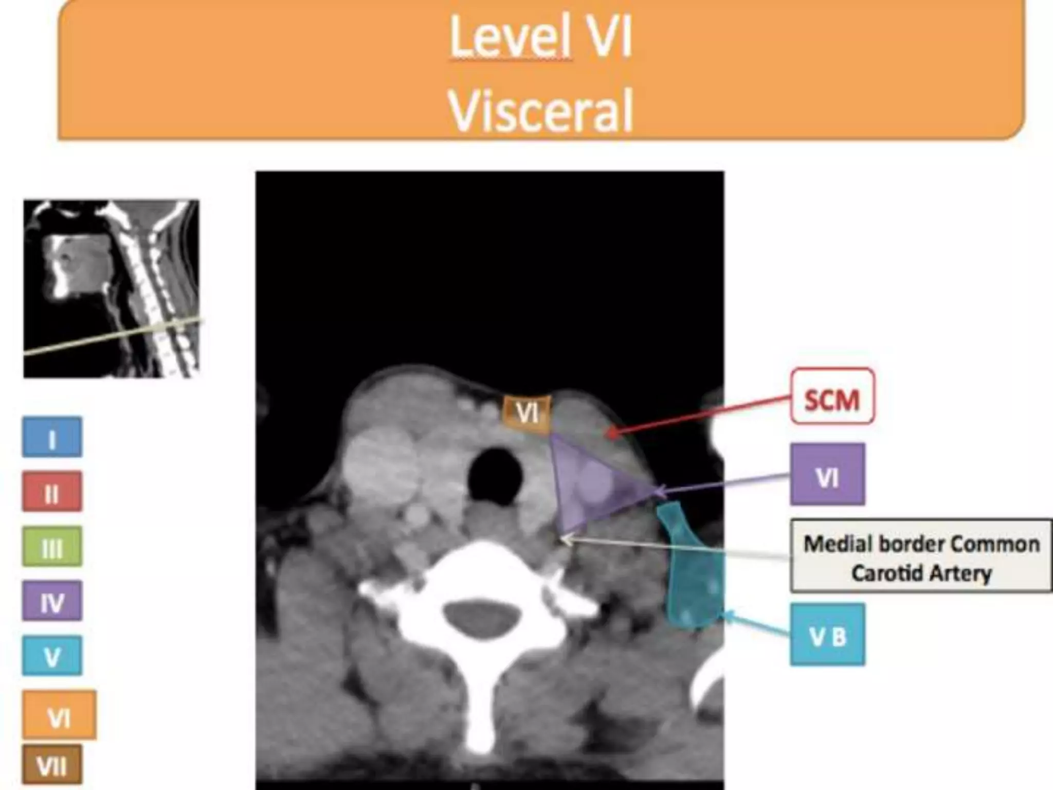 Levels of cervical nodes | PPT