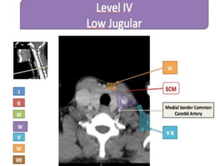 Levels of cervical nodes | PPTX