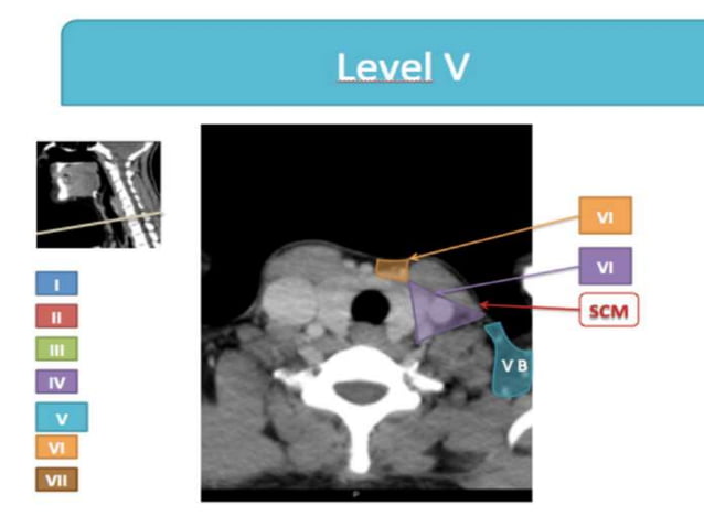 Levels of cervical nodes | PPTX