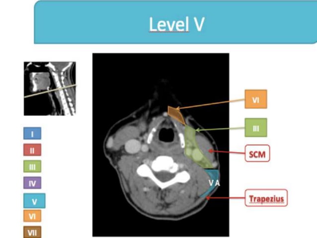 Levels of cervical nodes | PPTX