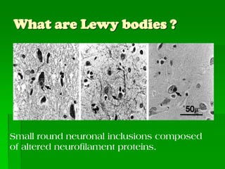 Lewy Body Dementia | PPTX