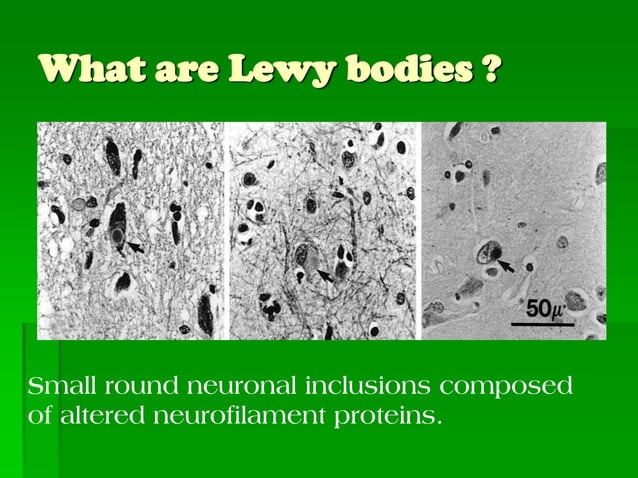 Lewy Body Dementia | PPTX | Brain and Nervous System Disorders ...