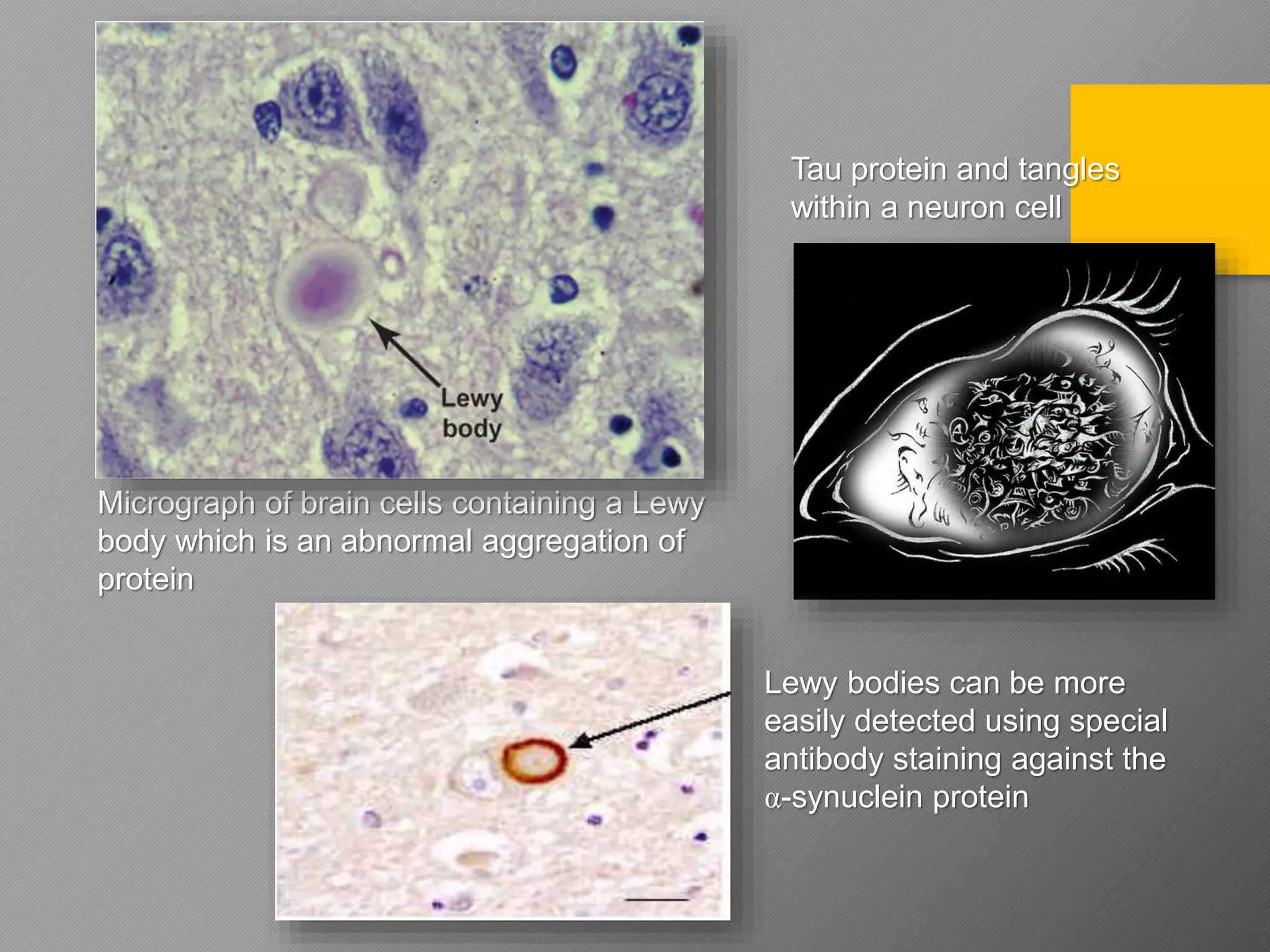 Lewy body dementia webinar final | PPTX