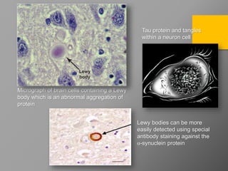 Lewy body dementia webinar final | PPTX