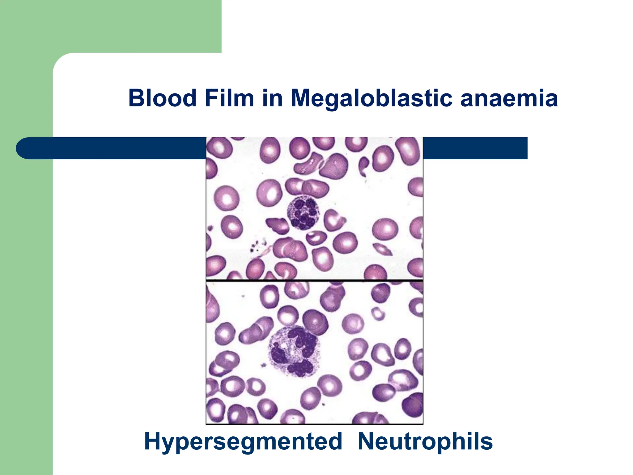 Vitamin B deficiency and Folic acid deficiency Megaloblastic anemias.ppt