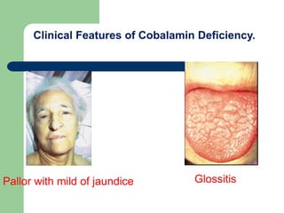 Vitamin B deficiency and Folic acid deficiency Megaloblastic anemias.ppt