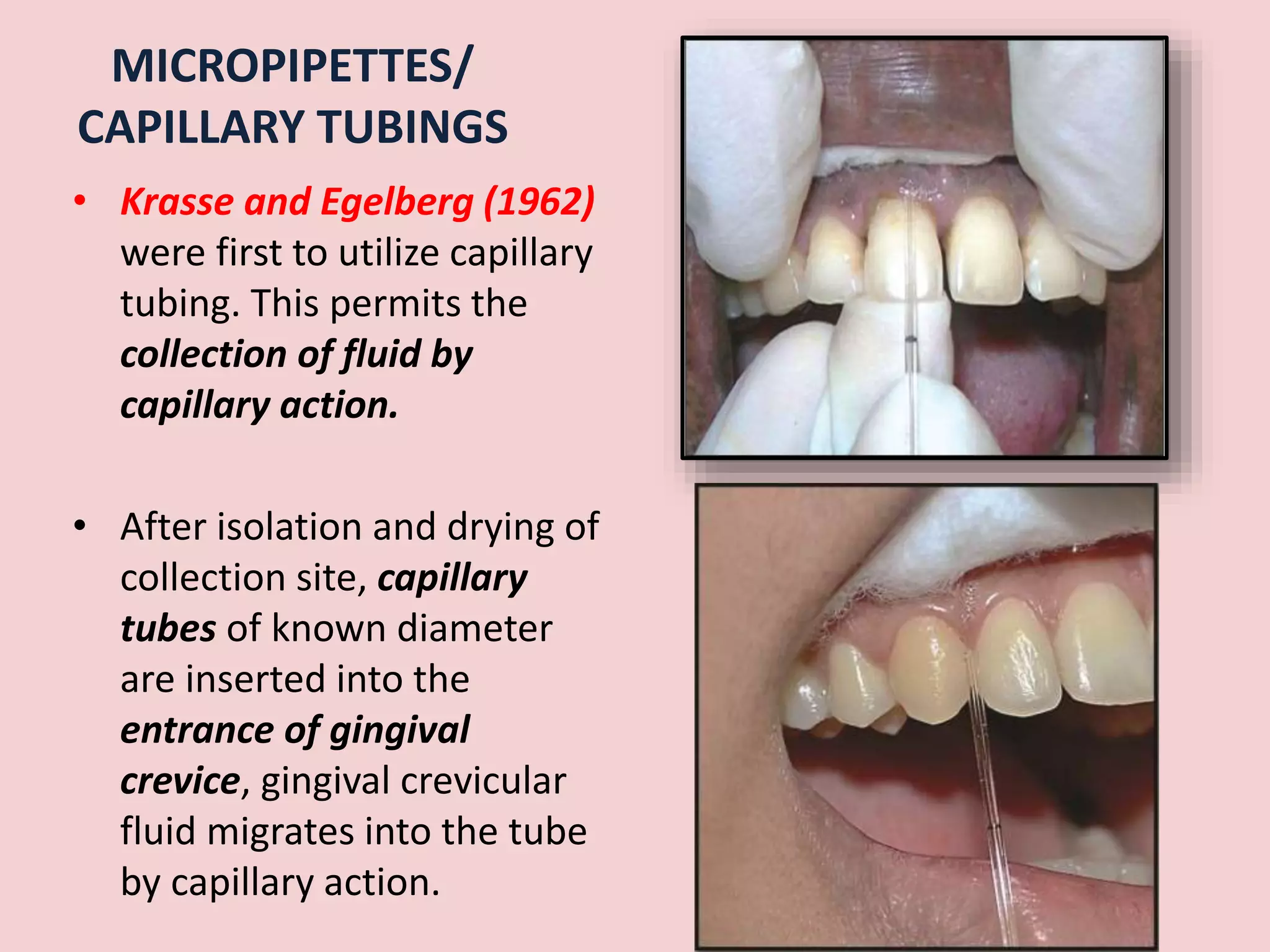 Gingival crevicular fluid | PPTX