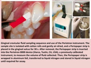 Gingival crevicular fluid | PPTX