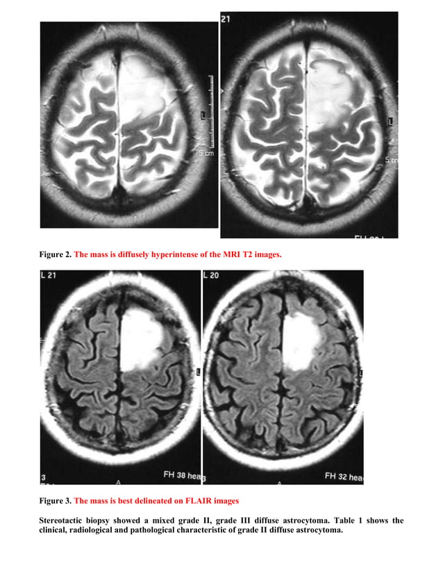 Case record... Grade II,III mixed astrocytoma | PDF