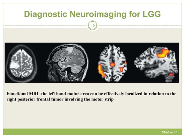 LOW GRADE GLIOMA controversies in management | PPTX