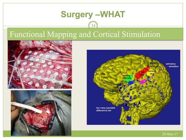 LOW GRADE GLIOMA controversies in management | PPTX