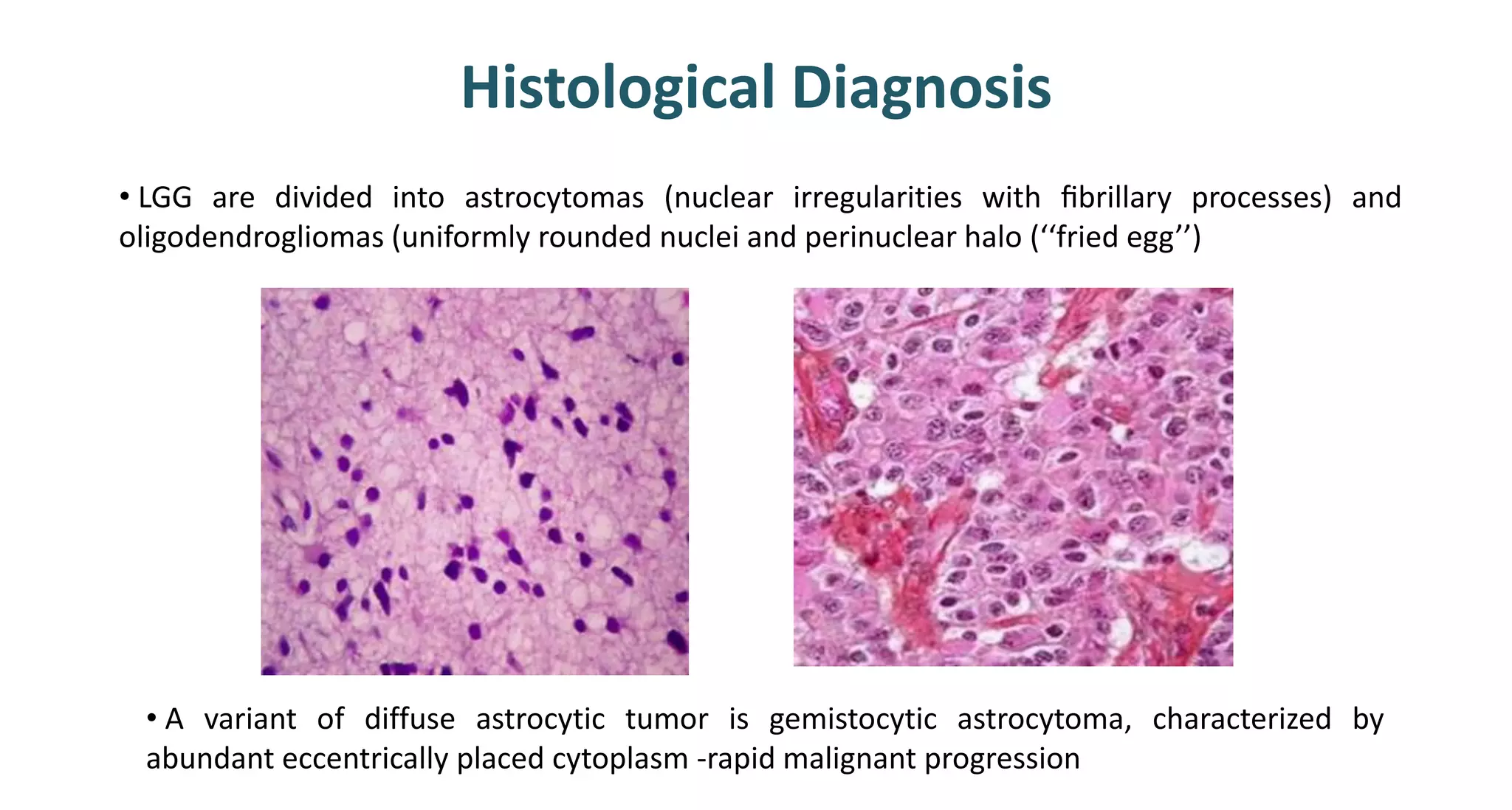 Management of Low Grade Glioma | PPTX