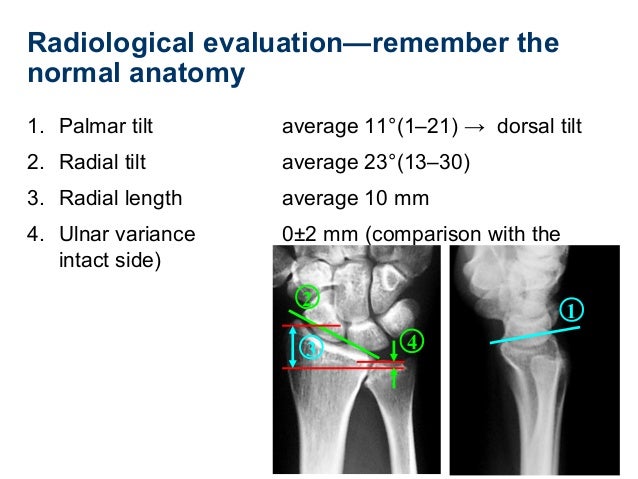 Distal Radius