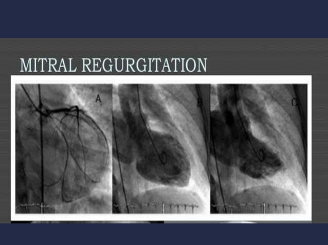 LEFT HEART CATHETERIZATION | PPTX | First Aid | Injuries