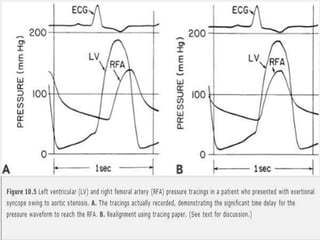 LEFT HEART CATHETERIZATION | PPTX