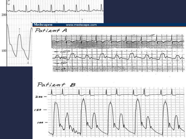 LEFT HEART CATHETERIZATION | PPT