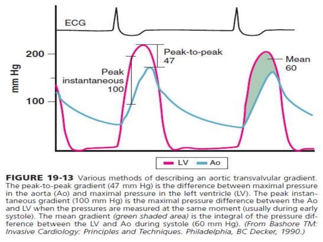 LEFT HEART CATHETERIZATION | PPT