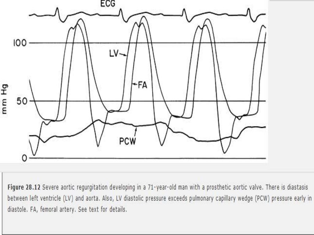 LEFT HEART CATHETERIZATION